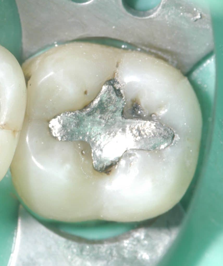 Bezpieczne usuwanie amalgamatów - Szczegóły zabie